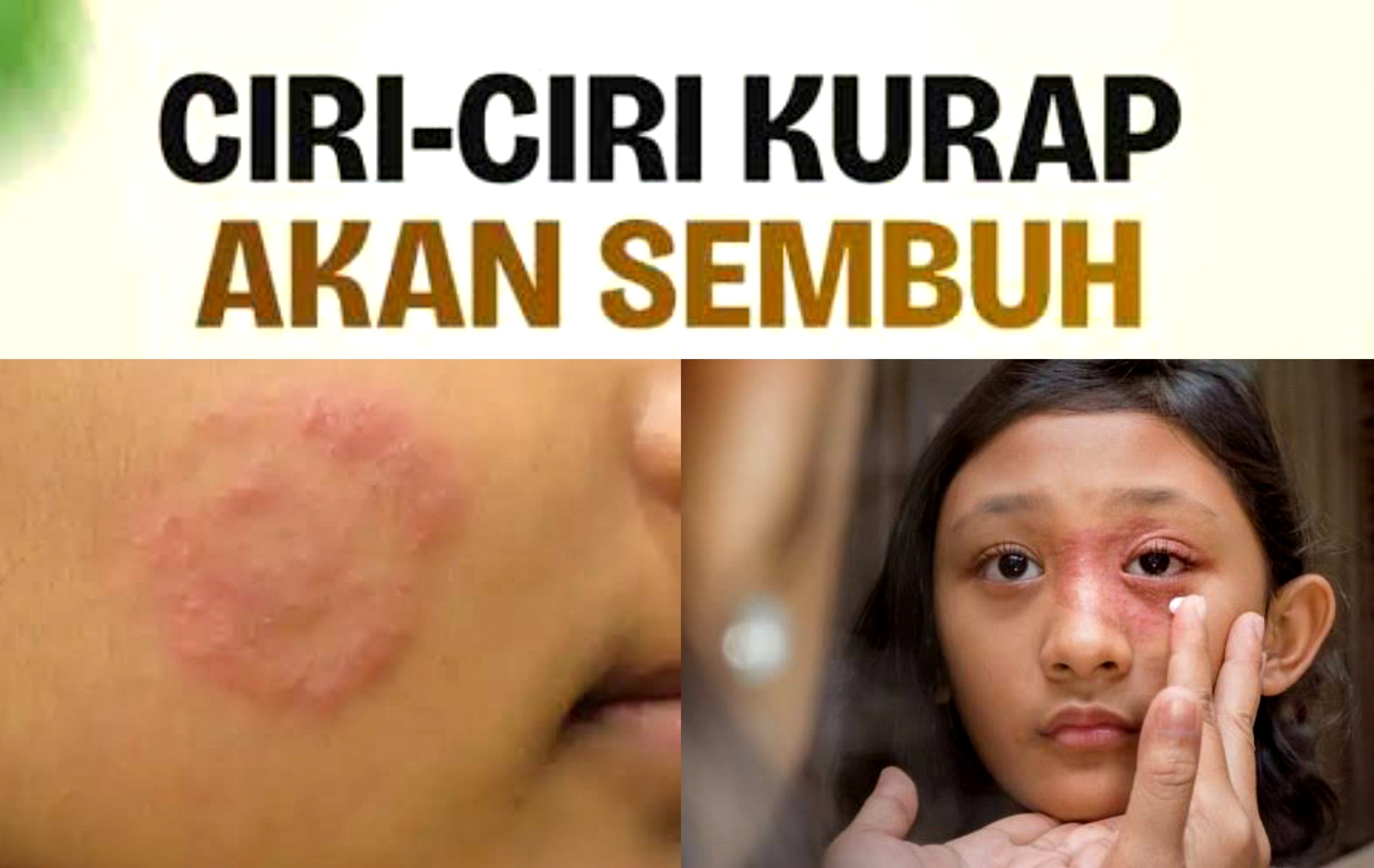 5 Ciri-ciri Kurap Akan Sembuh dan Cara Mencegahnya Timbul Kembali
