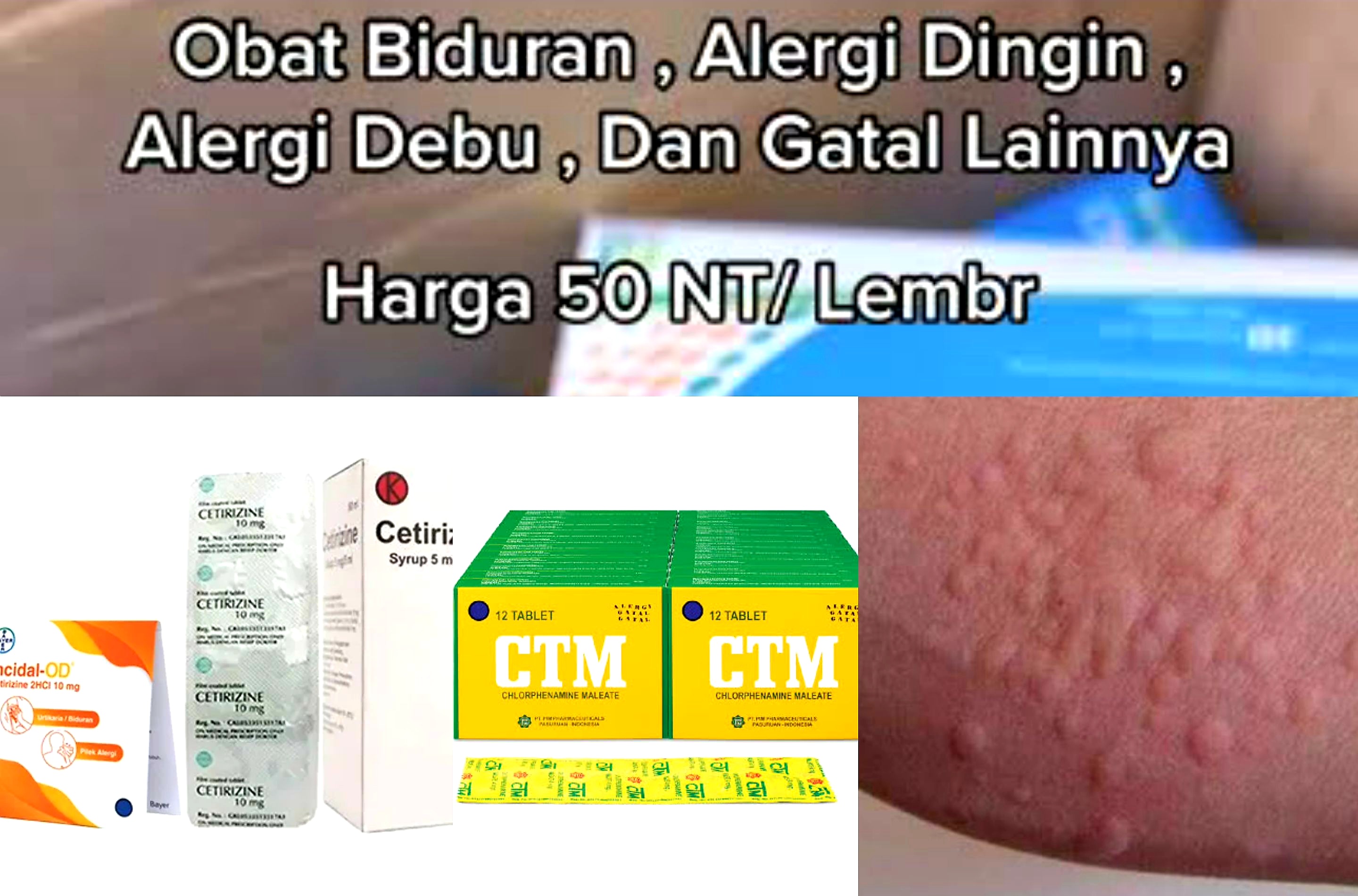 Ampuh! Rekomendasi 4 Obat Biduran Efektif di Apotek Disertai Harganya