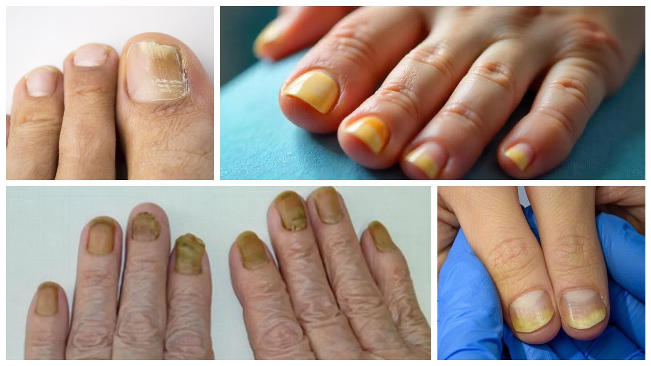 Ketahuilah, Penyebab dan Penanganannya Sindrom Kuku Kuning, Ini ...