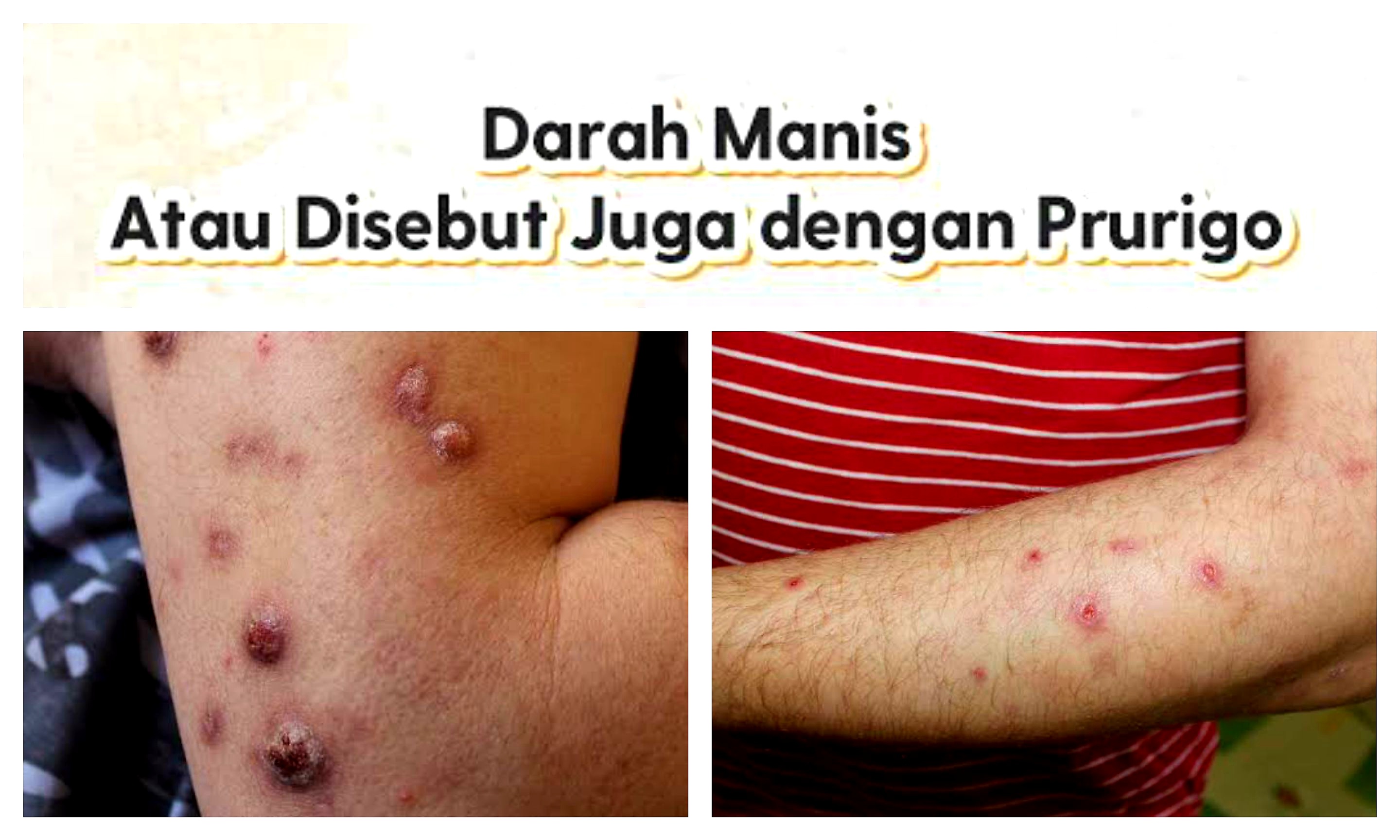 Segera Cek. Kenali 3 Ciri-Ciri Darah Manis Prurigo yang Harus Diwaspadai